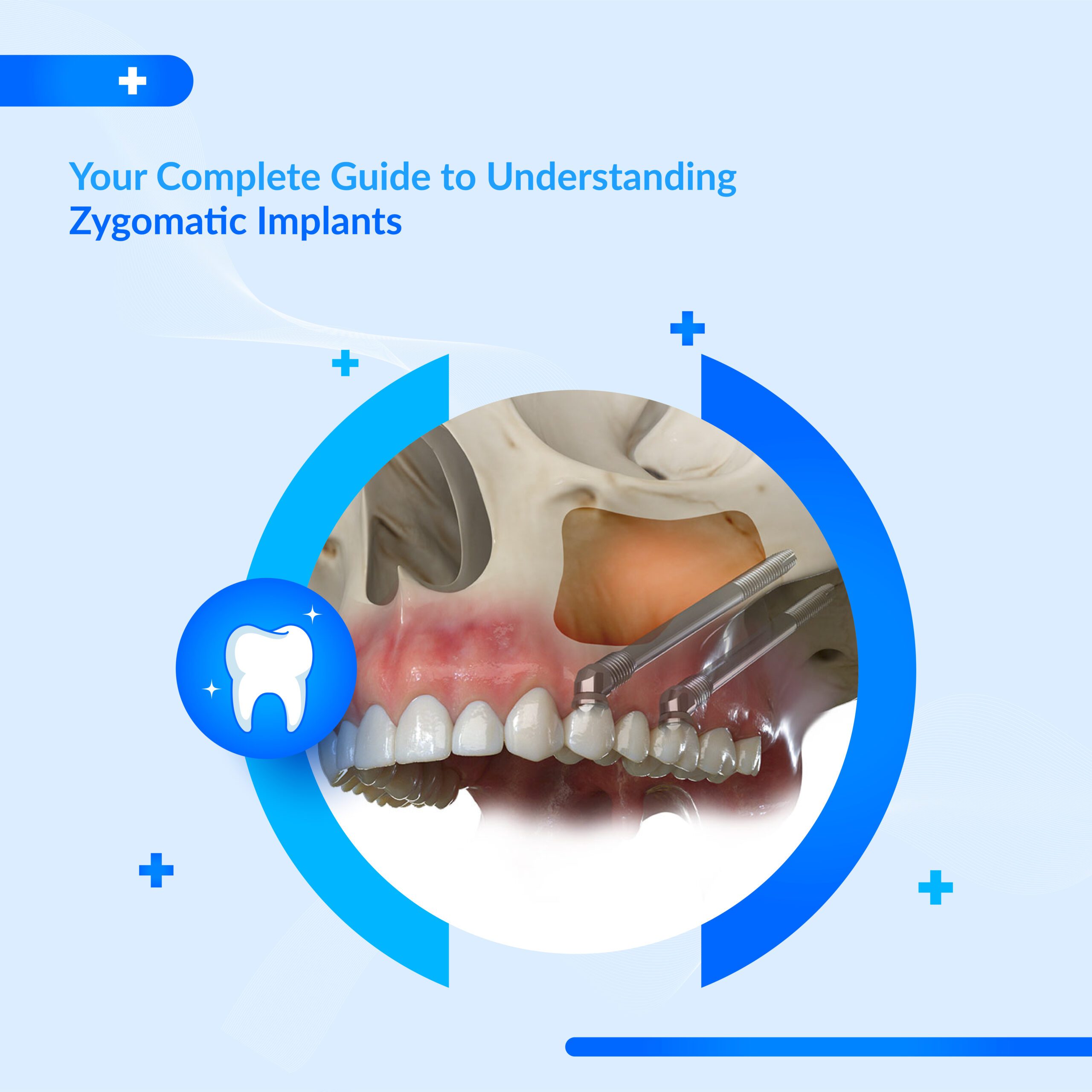 Zygomatic Implants | Complete Guide for Severe Bone Loss