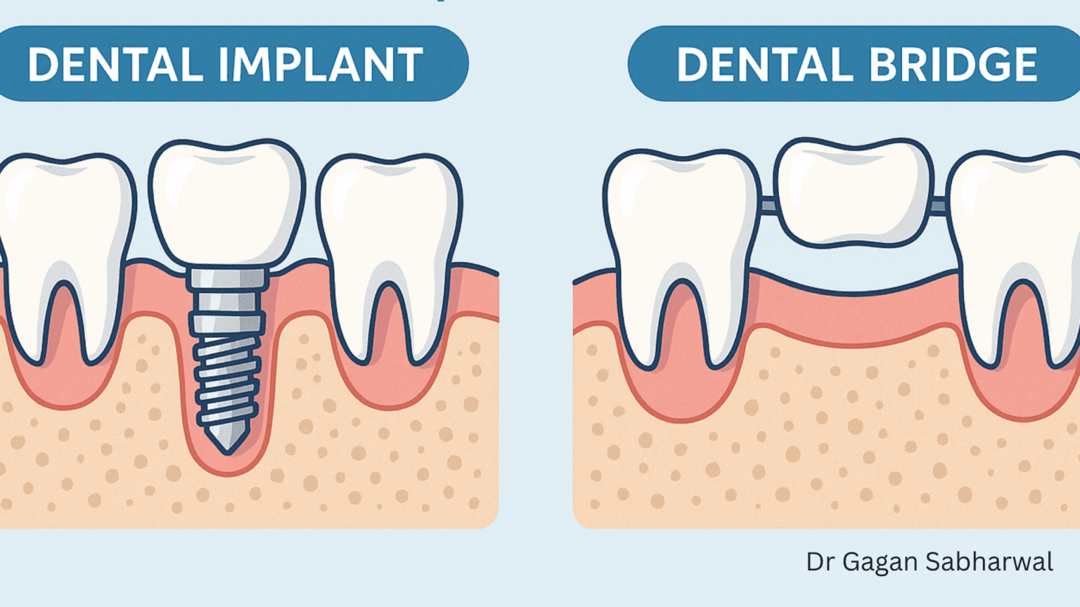 Dental Implant vs Bridge | Best Tooth Replacement Dubai